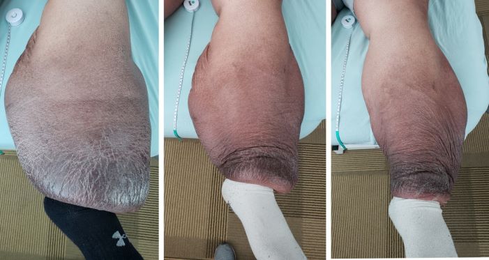 Lymphedema